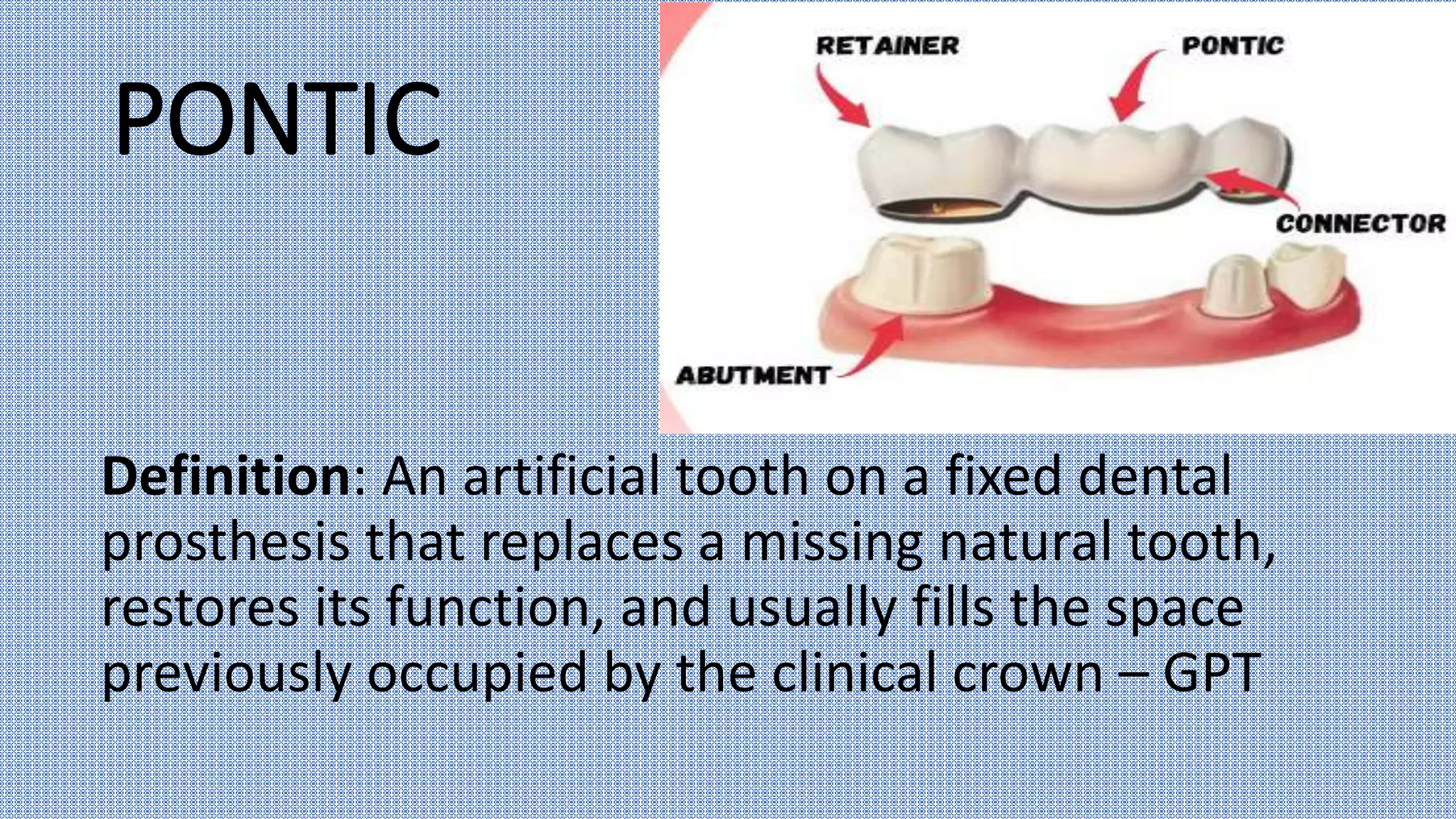 PARTS OF FIXED PARTIAL DENTURE.pptx