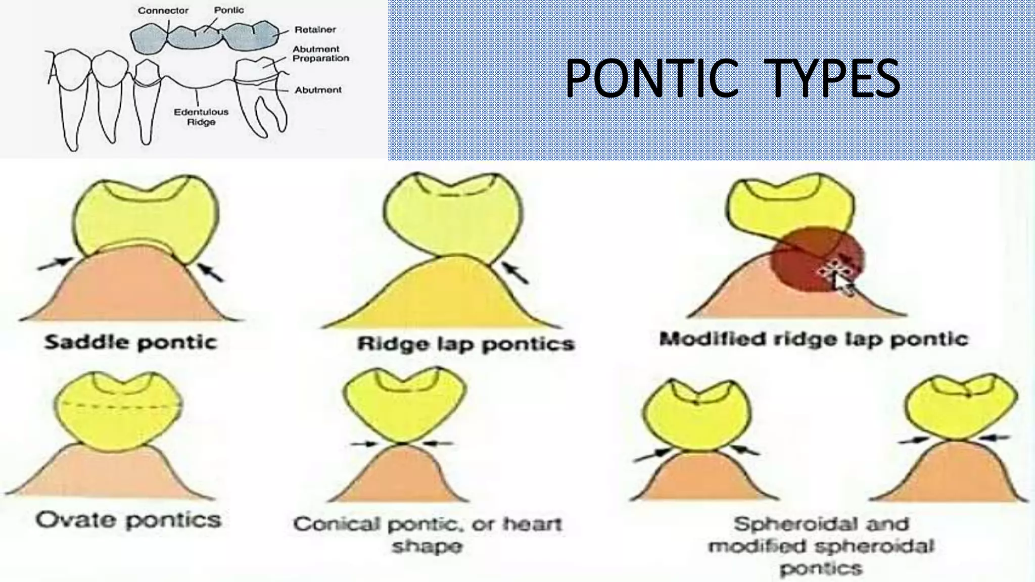 PARTS OF FIXED PARTIAL DENTURE.pptx