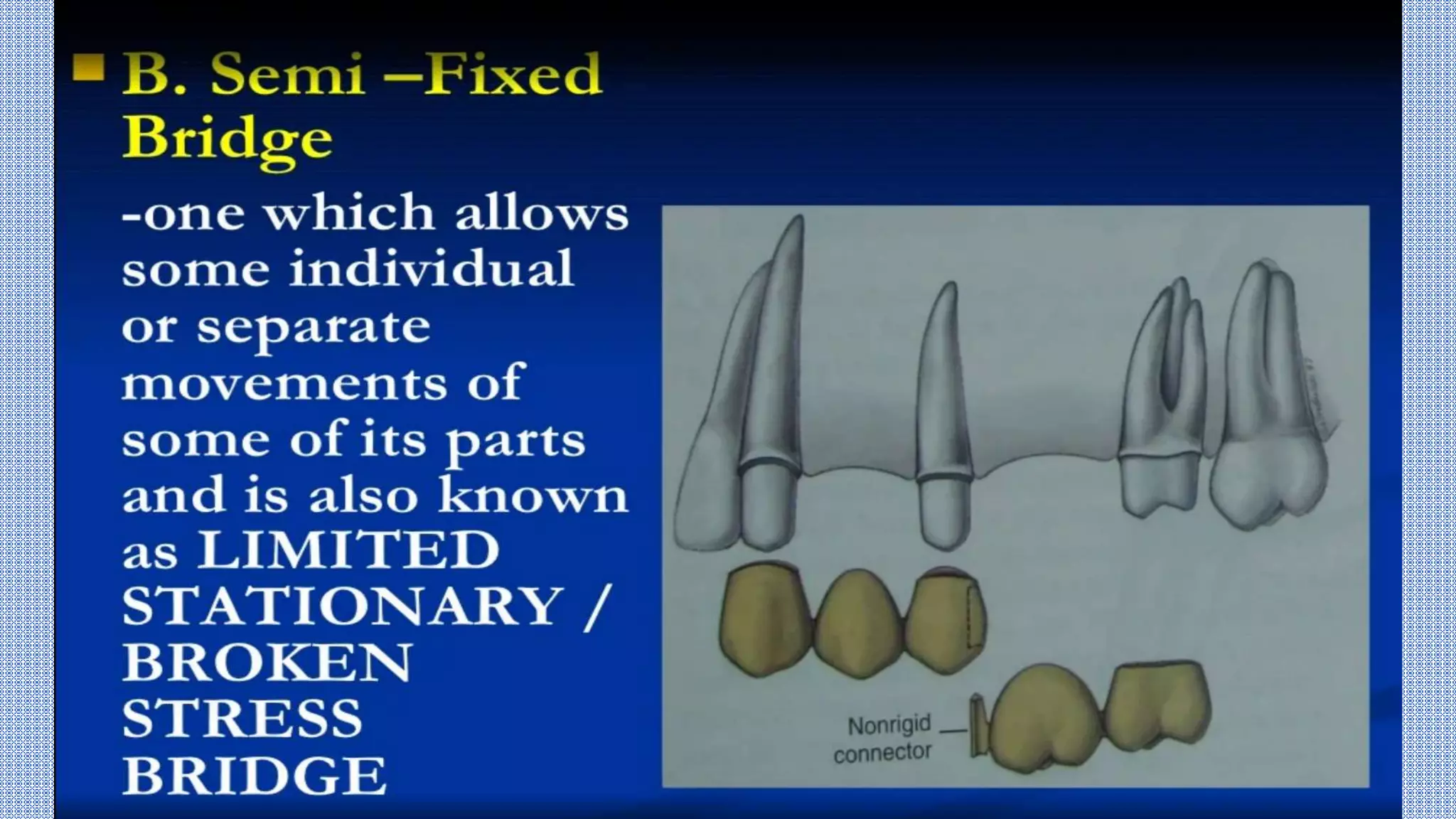 PARTS OF FIXED PARTIAL DENTURE.pptx