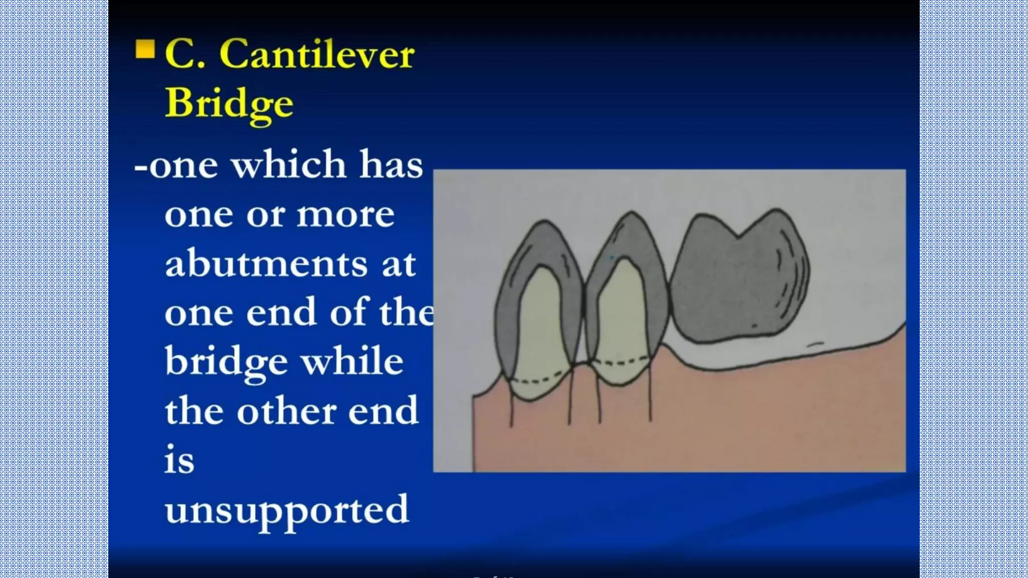 PARTS OF FIXED PARTIAL DENTURE.pptx