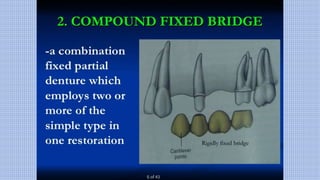 PARTS OF FIXED PARTIAL DENTURE.pptx