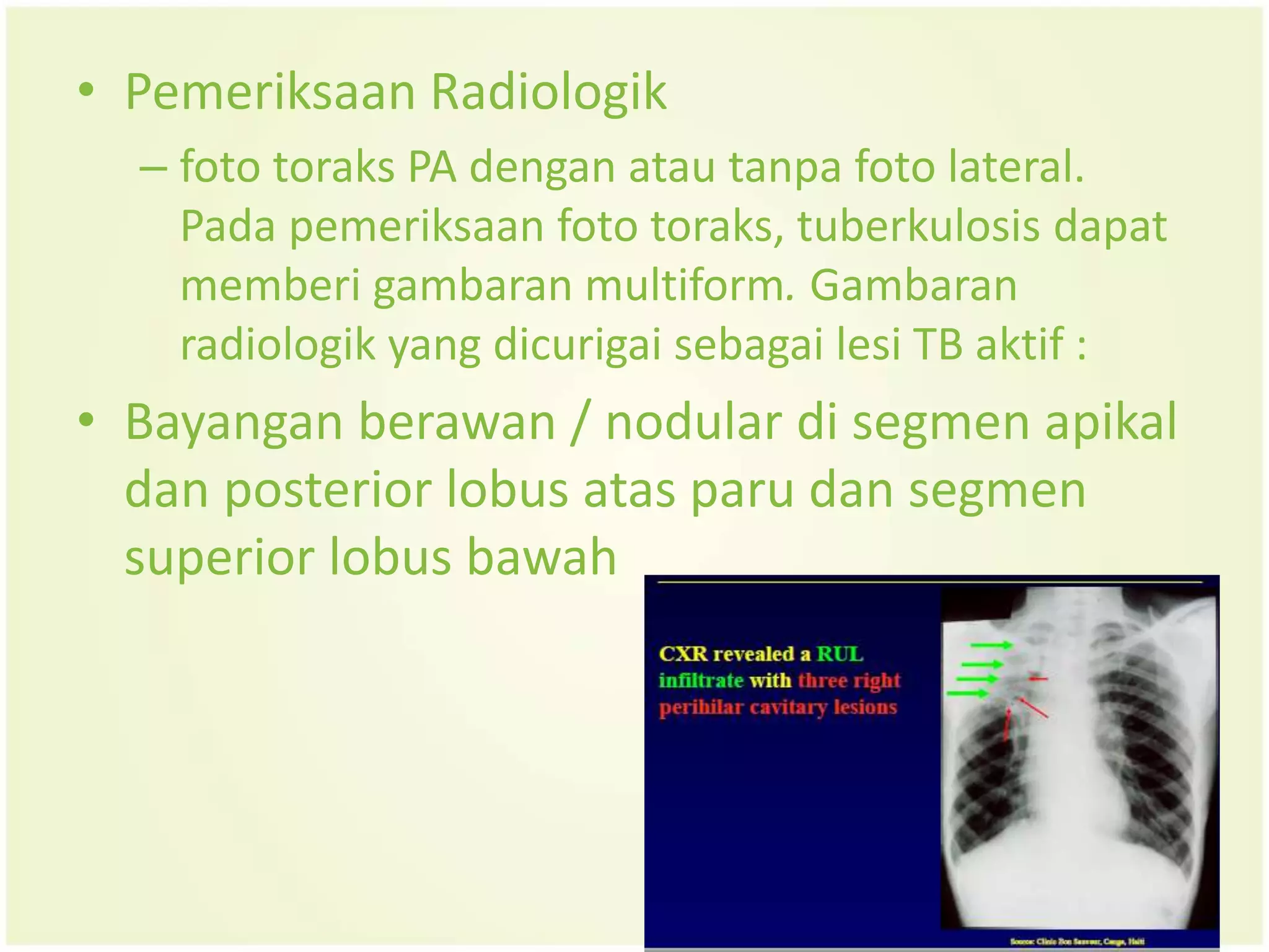 CASE REPORT TUBERKULOSIS PARU | PPTX