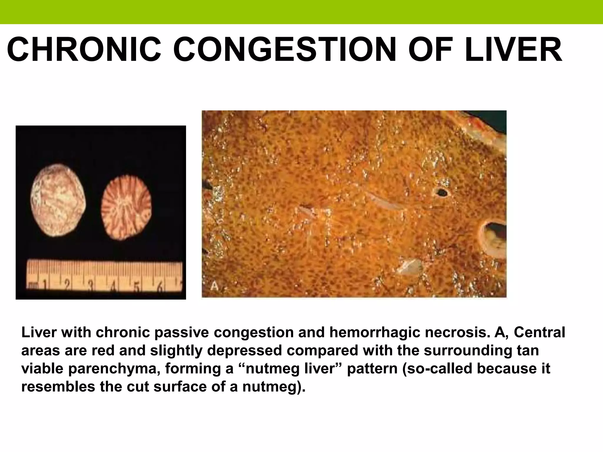 parvati- hemo- final.pptx