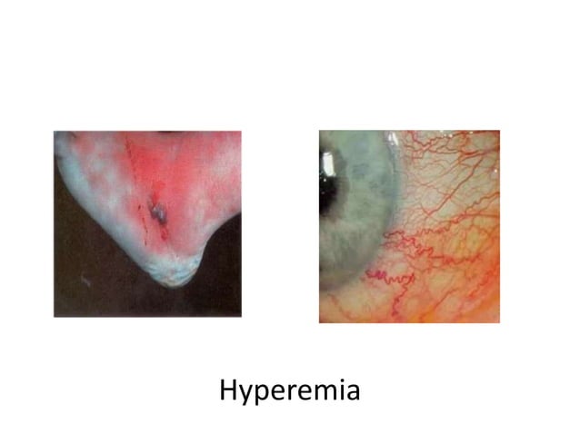 parvati- hemo- final.pptx