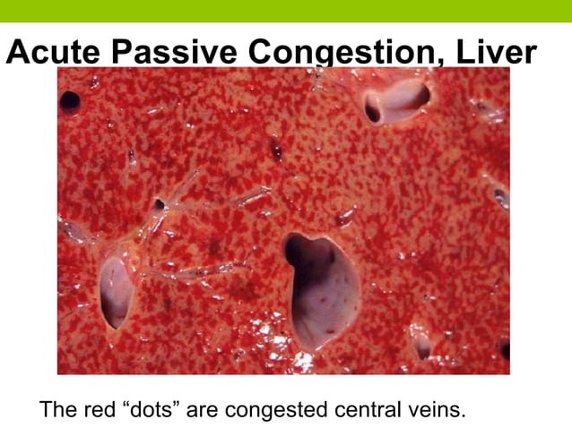 parvati- hemo- final.pptx