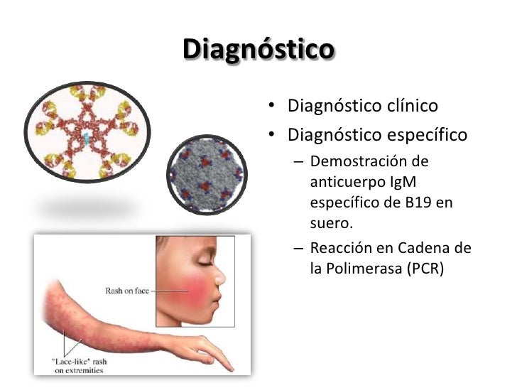 Parvovirus