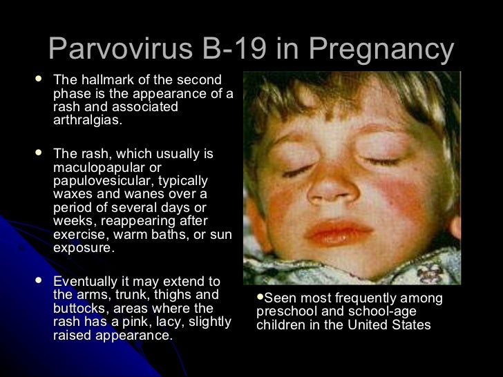 Parvovirus