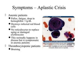 Parvovirus b19 | PPT