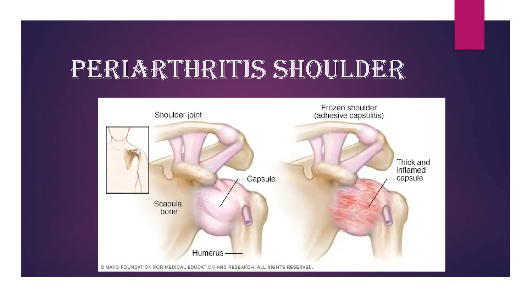 PERIARTHRITIS SHOULDER EXPLAINED IN DETAIL | PPTX