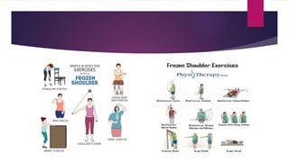 PERIARTHRITIS SHOULDER EXPLAINED IN DETAIL | PPTX