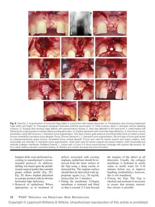 “PASS” Principles for Predictable Bone Regeneration | PDF