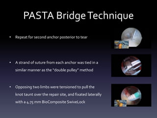PASTA Bridge - A New Technique in PASTA Repairs: A Biomechanical ...