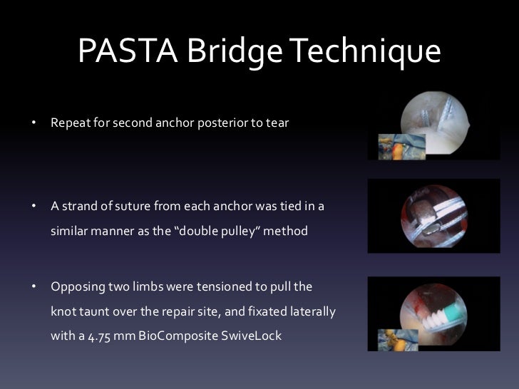 PASTA Bridge - A New Technique in PASTA Repairs: A Biomechanical Eval…