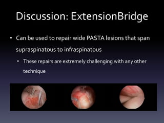 PASTA Bridge - A New Technique in PASTA Repairs: A Clinical Evaluation ...