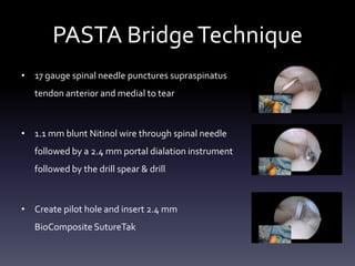 PASTA Bridge - A New Technique in PASTA Repairs: A Clinical Evaluation ...