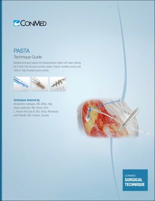 4 Techniques for Transtendinous PASTA Repair | PDF