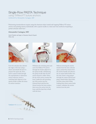 4 Techniques for Transtendinous PASTA Repair | PDF