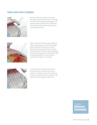 4 Techniques for Transtendinous PASTA Repair | PDF