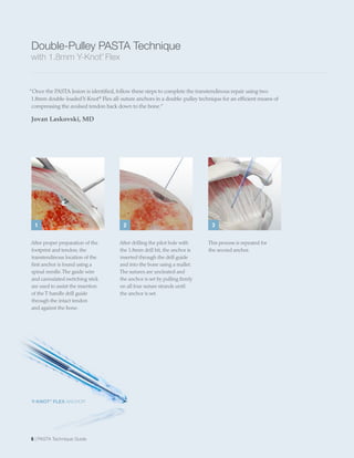 4 Techniques for Transtendinous PASTA Repair | PDF
