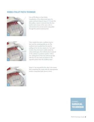 4 Techniques for Transtendinous PASTA Repair | PDF