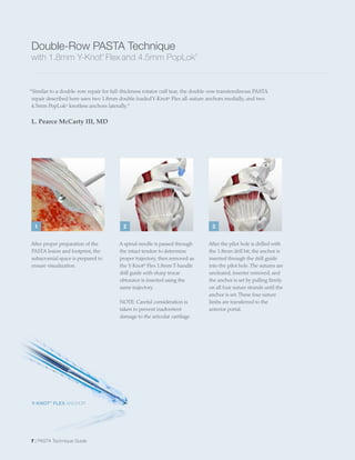 4 Techniques for Transtendinous PASTA Repair | PDF