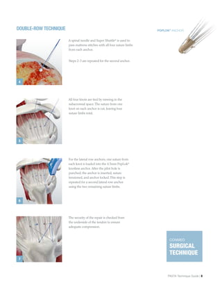 4 Techniques for Transtendinous PASTA Repair | PDF