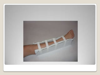 Patah+tulang+dan+pembidaian | PPTX