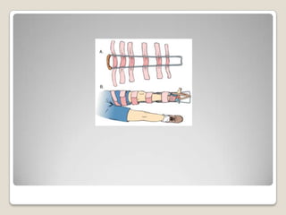 Patah+tulang+dan+pembidaian | PPTX