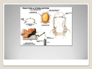 Patah+tulang+dan+pembidaian | PPTX