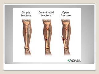 Patah+tulang+dan+pembidaian | PPTX