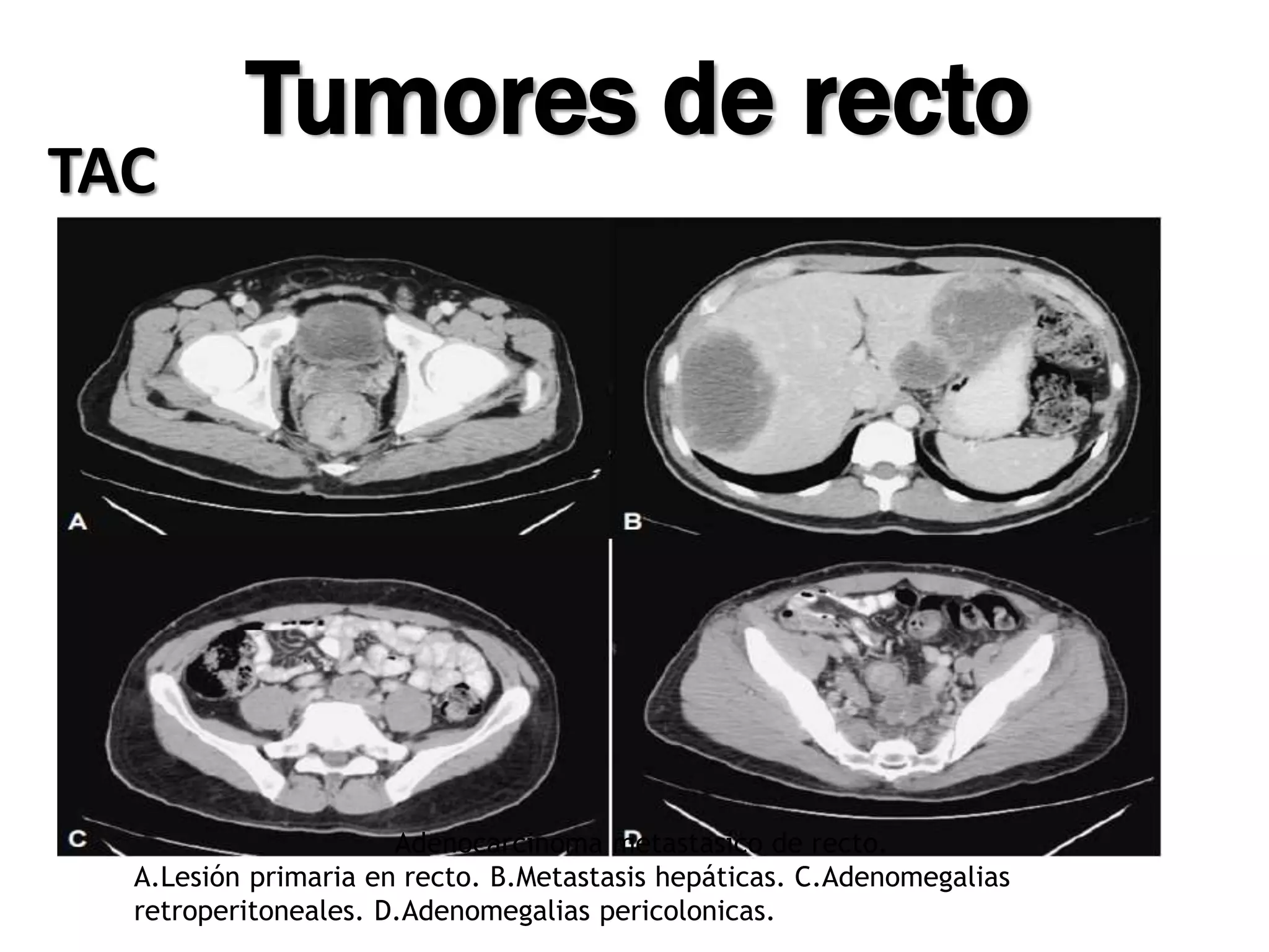 patologia Ano Rectal.pptx | PPT