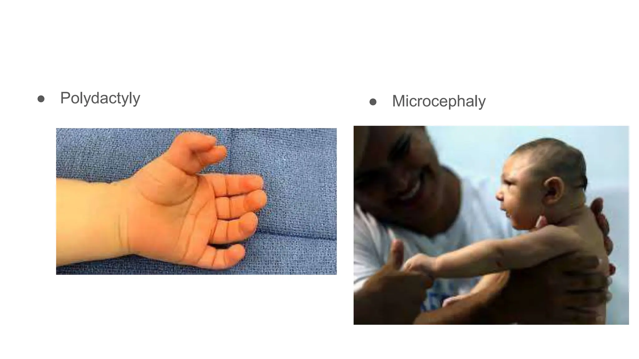 Patau's Syndrome presentationon genetics.pptx