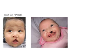 Patau's Syndrome presentationon genetics.pptx