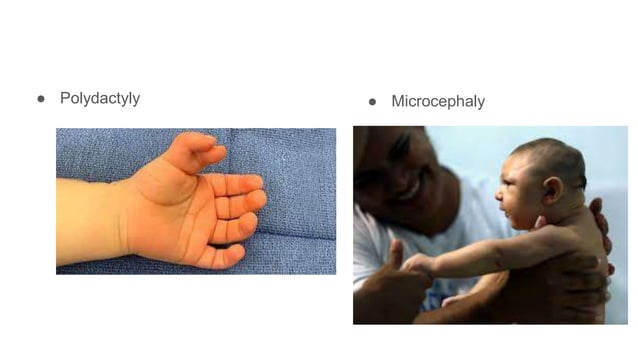 Patau's Syndrome presentationon genetics.pptx