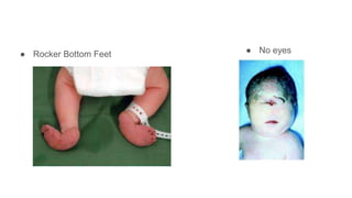 Patau's Syndrome presentationon genetics.pptx