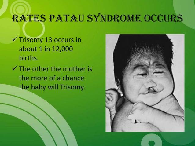 Patau Syndrome | PPTX | Brain and Nervous System Disorders | Diseases ...