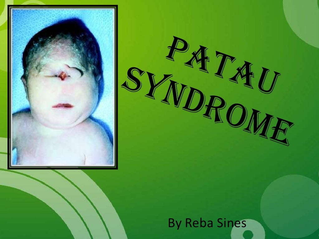 Patau Syndrome