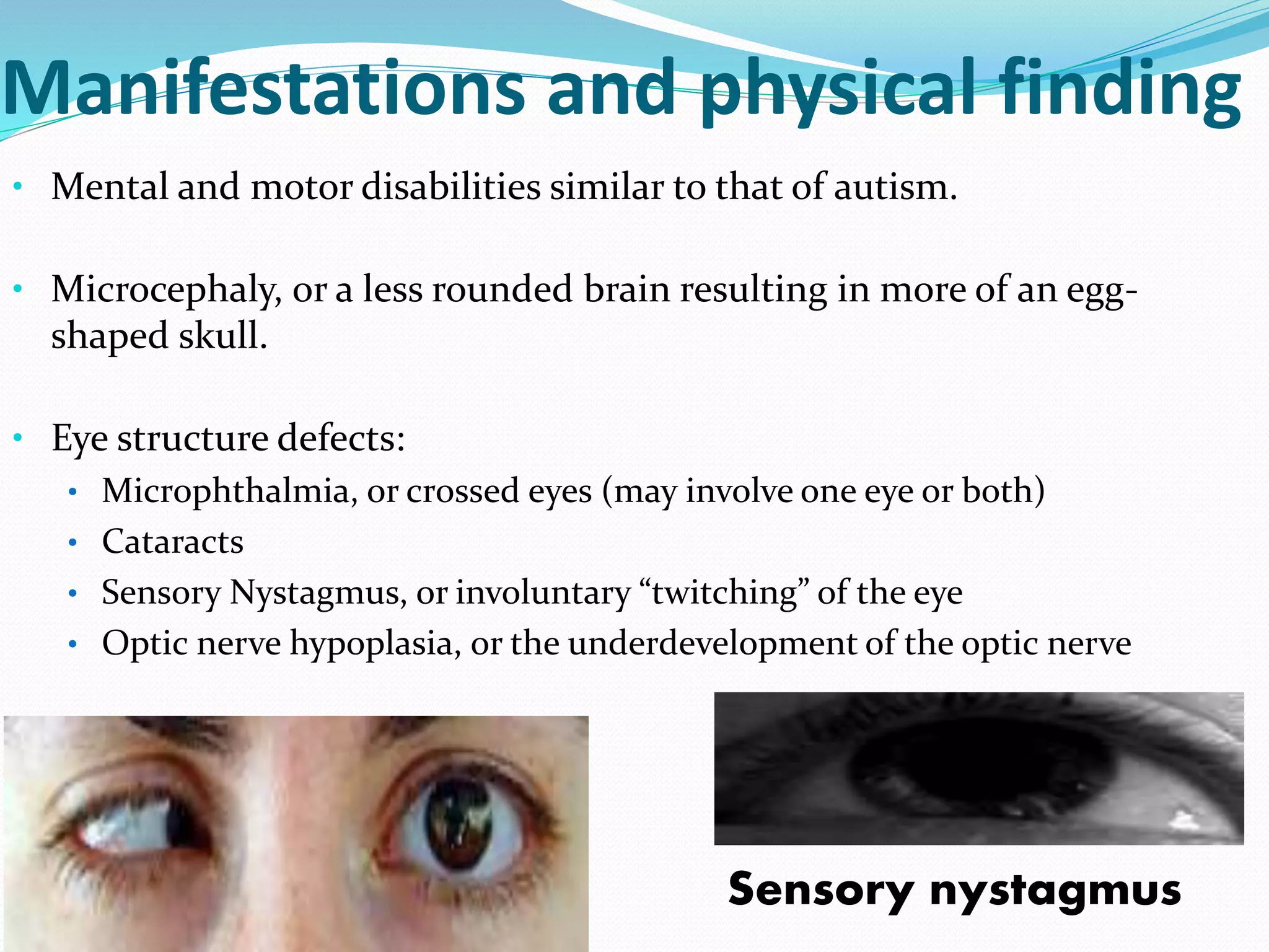 Patau syndrome | PPTX