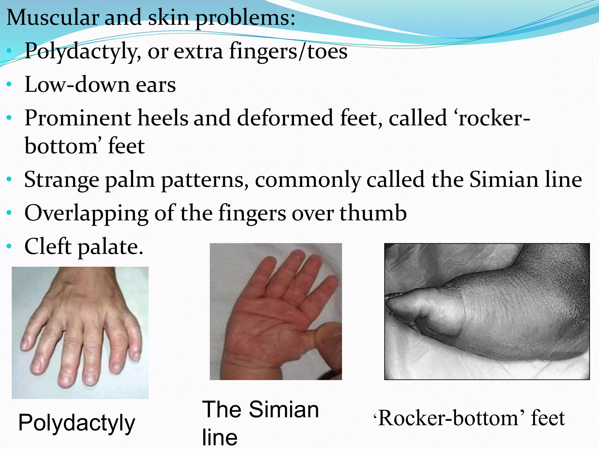 Patau syndrome | PPTX