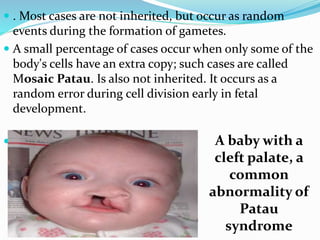 Patau syndrome | PPTX