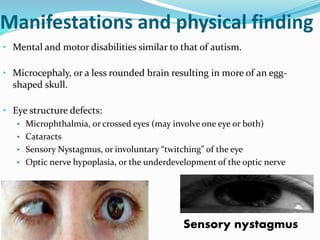 Patau syndrome | PPTX