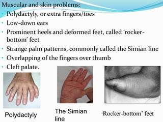 Patau syndrome | PPTX