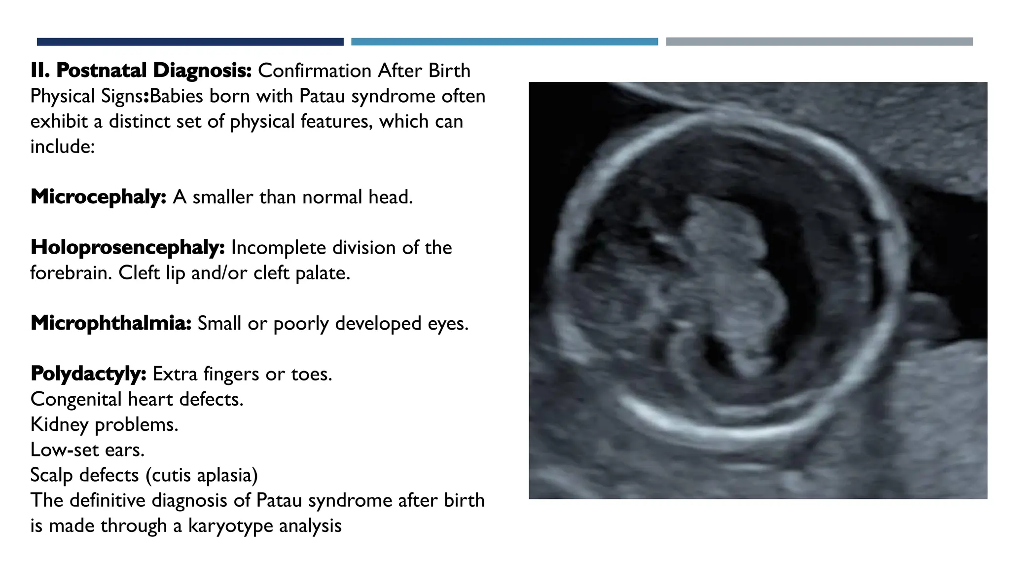 PATAU SYNDROME which is a sexlinked disease.pdf