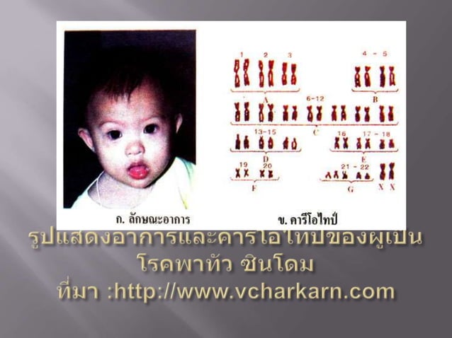 Patau syndrome เมื่อมีโครโมโซมคู่ที่ 13 | PPT