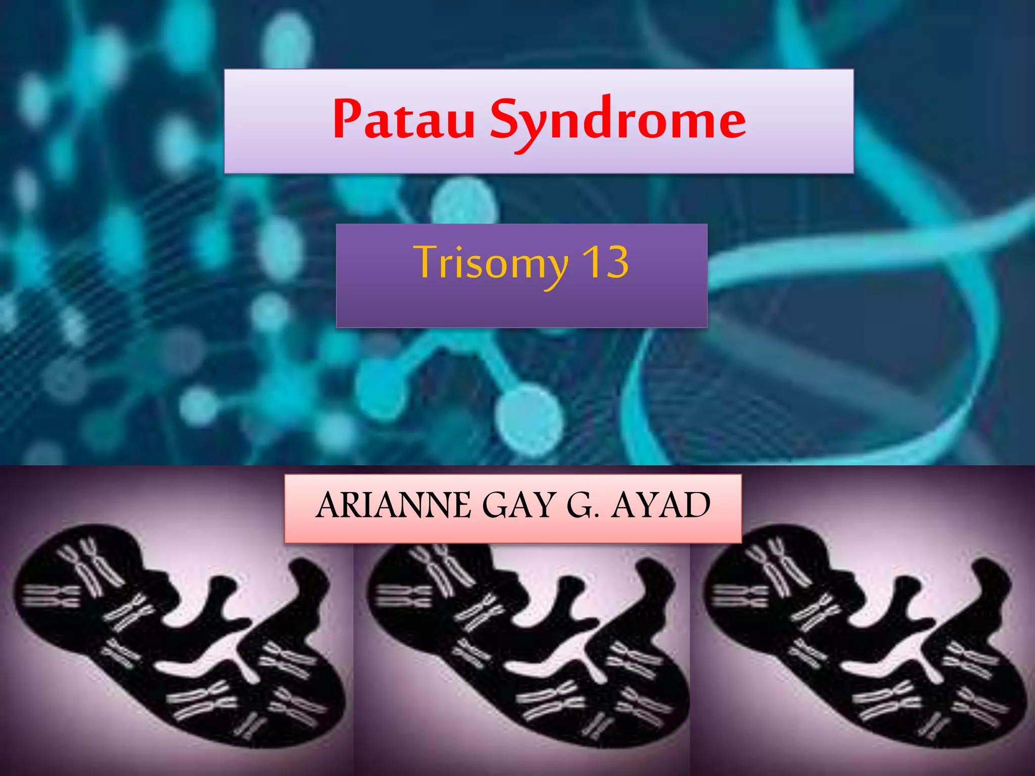 Patau Syndrome | PPTX