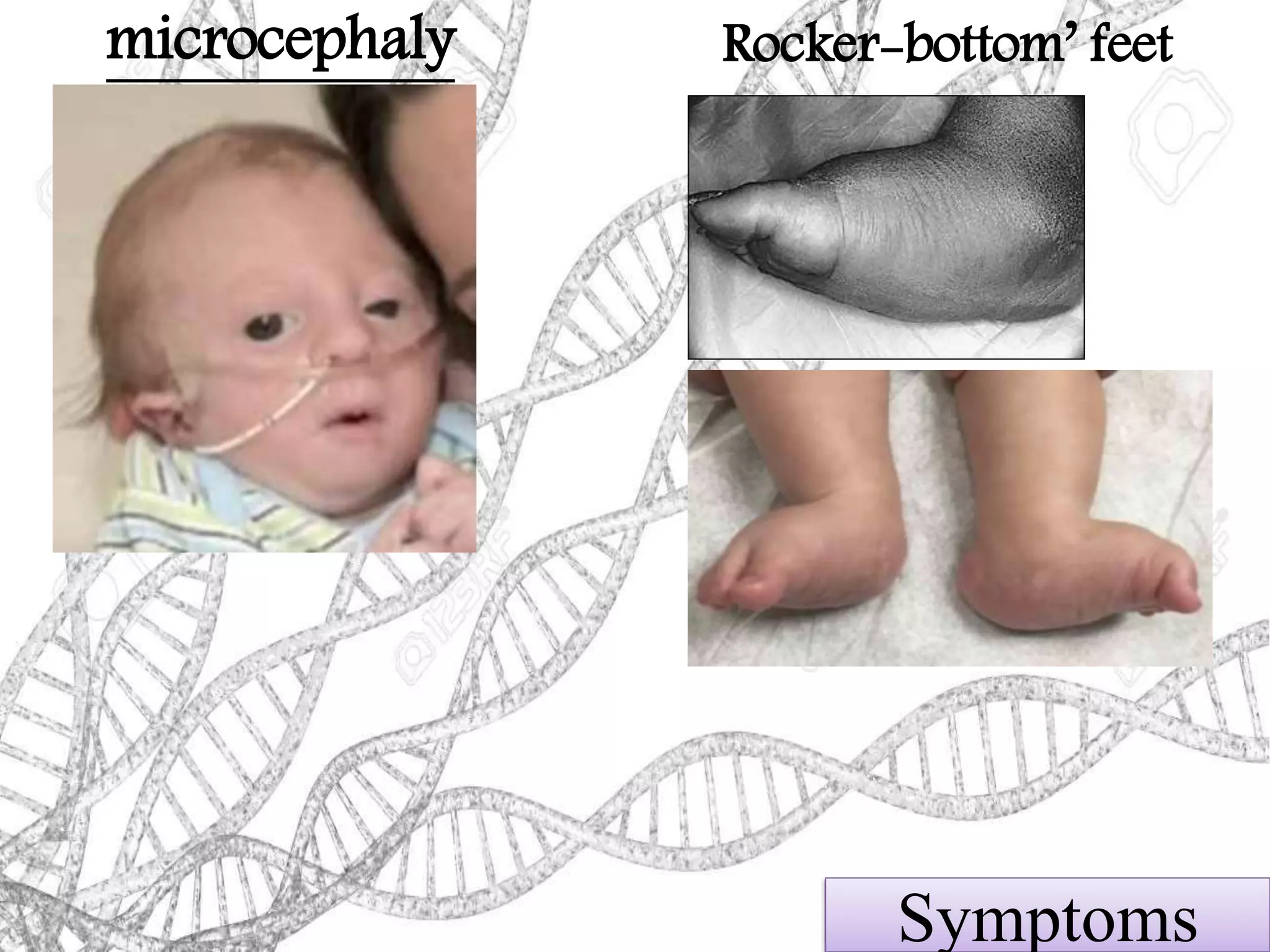 Patau Syndrome | PPTX