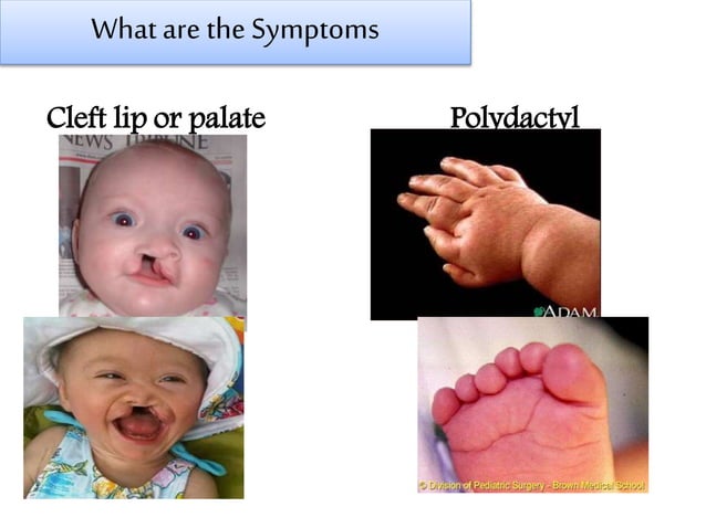 Patau Syndrome