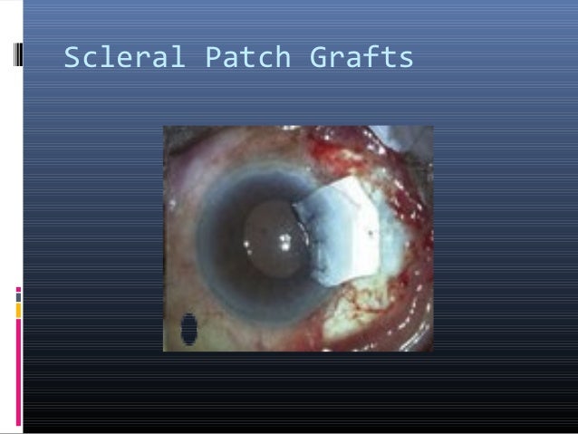 Tutoplast Patch Graft
