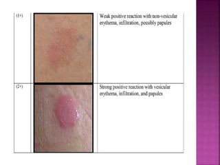 Patch test in dermatology | PPTX