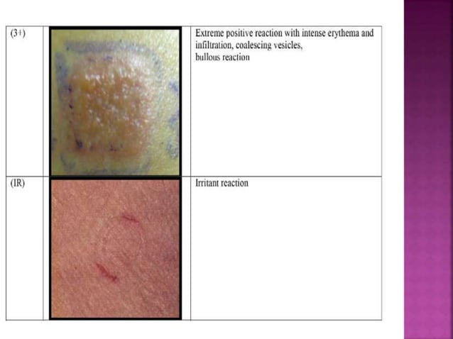 Patch test in dermatology | PPTX